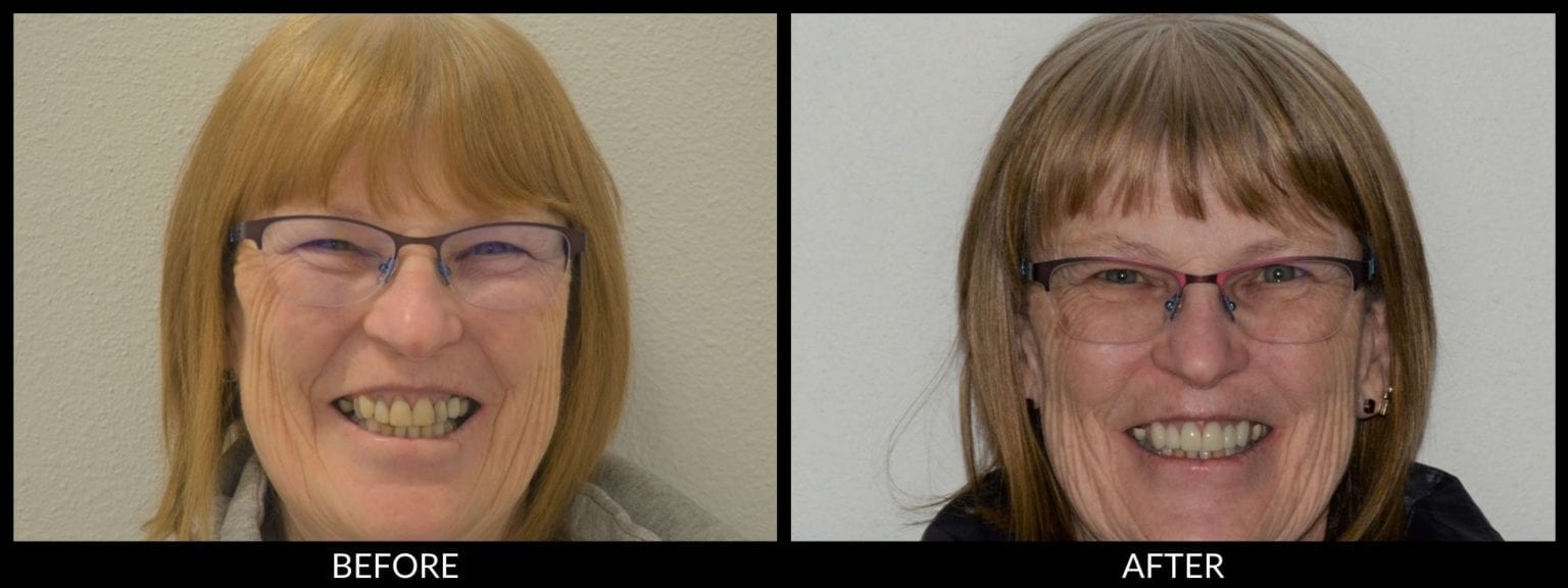 Smile Makeover in in Tri-Cities WA | Kennewick, Richland, Pasco